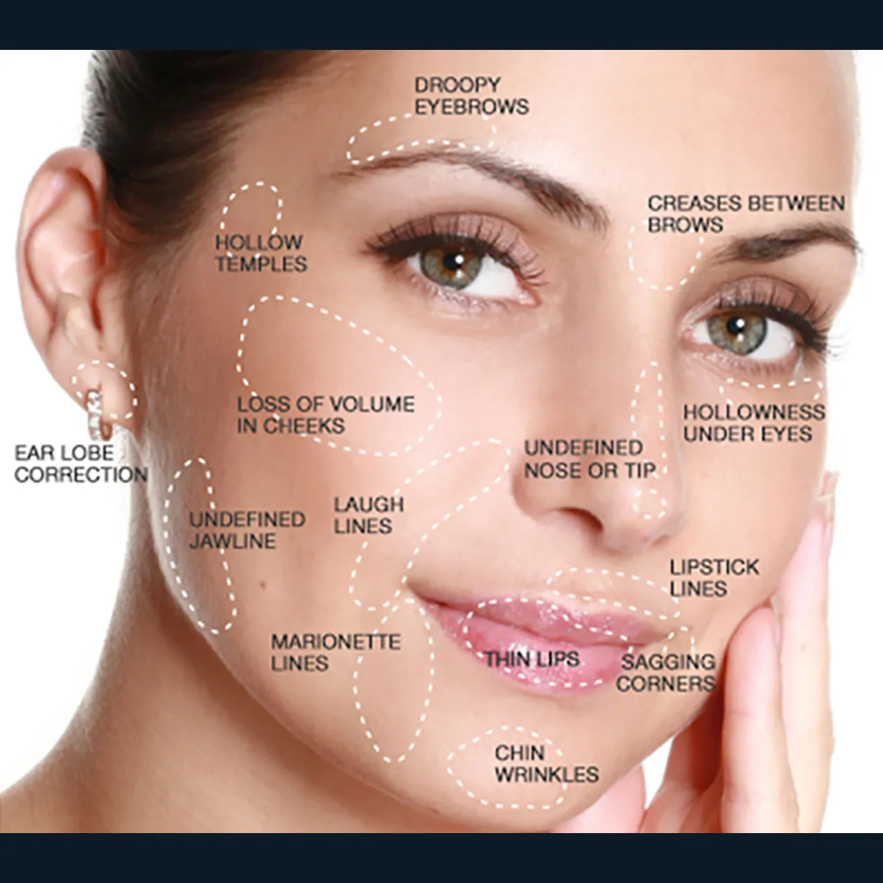 Dermal Fillers | Polynucleotide Treatment London | Solihull